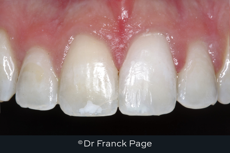 Aesthetic Composite Resin Restorations - Dental Implants